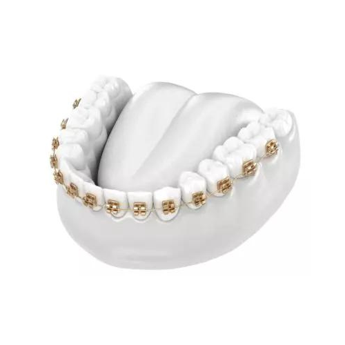 All About Iconix Gold Braces | Fredericksburg Orthodontics All About Iconix Gold Braces | Fredericksburg Orthodontics